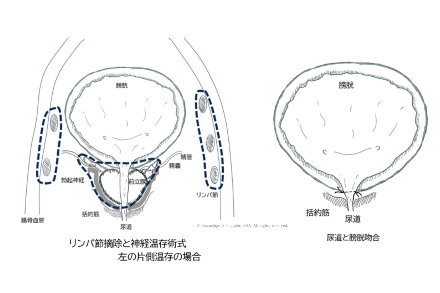 ロボット前立腺全摘（RARP）の解説｜虎ノ門 泌尿器外科医 阪口和滋 | 虎ノ門の泌尿器外科医